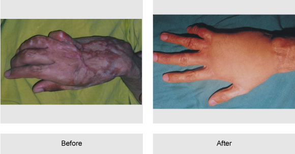 Dr A Mistry's Clinic - Burns